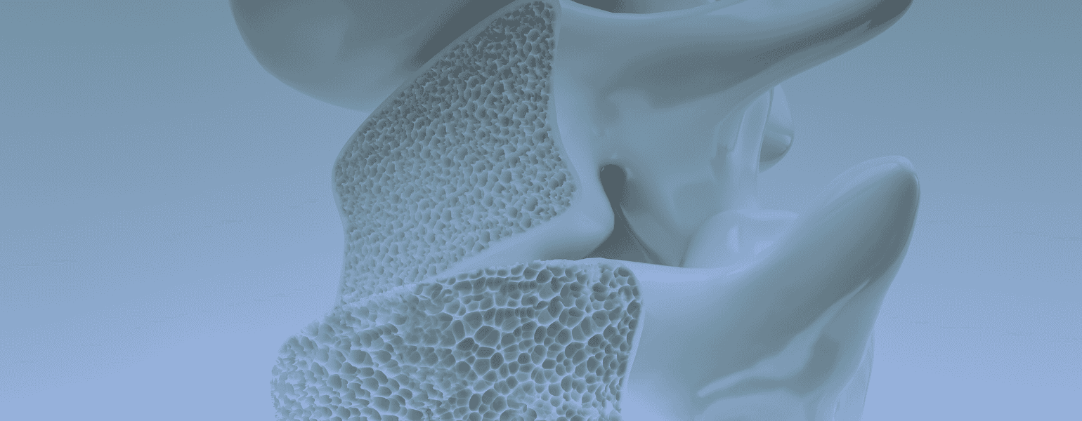 Osteoporosis - Vero Orthopaedics